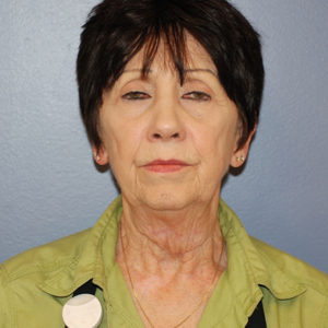 Facelift Archives - Ethos Plastic Surgery | Ginger Xu, MD