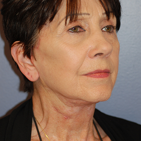 Facelift & Neck Lift Case 435 - Ethos Plastic Surgery | Ginger Xu, MD