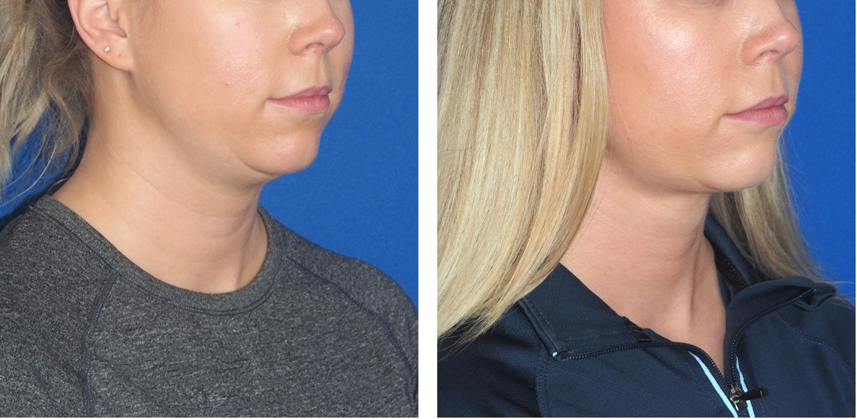 Buccal Fat Removal & Submental Liposuction San Francisco | Ethos ...